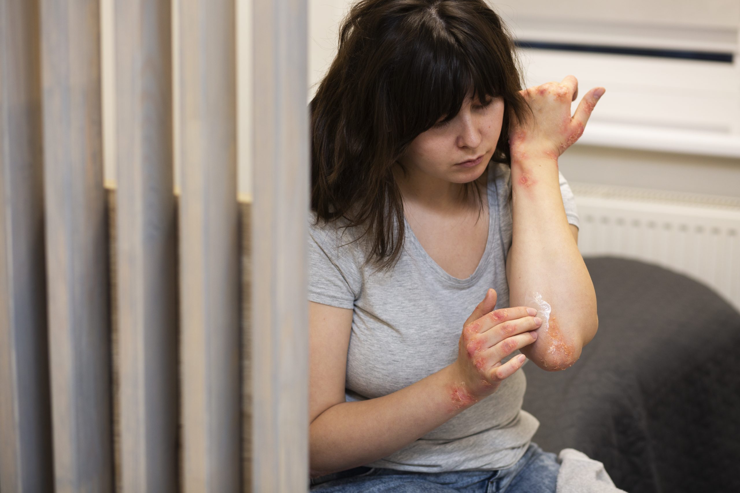 Piqûres d'acariens : symptômes, prévention et traitement